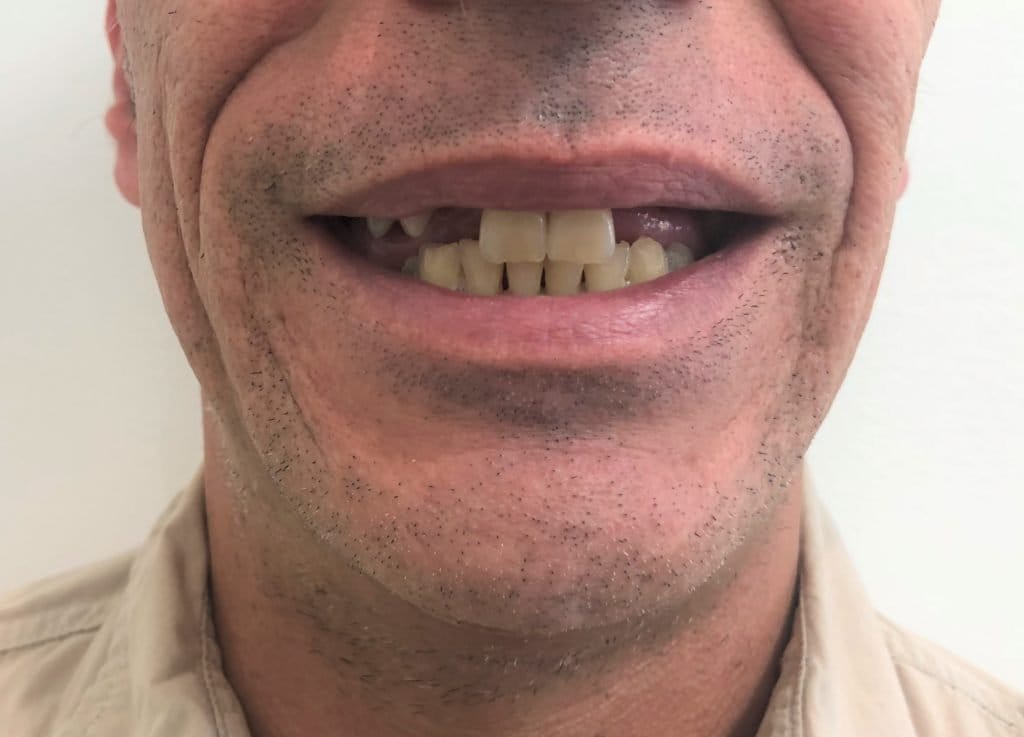 How to Fix Missing Teeth